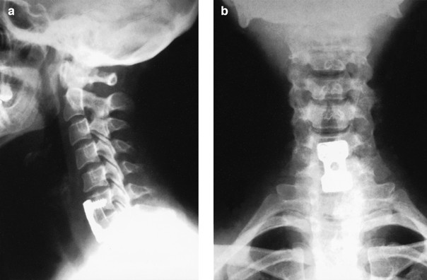 Unilateral cervical facet fracture: presentation of two cases and ...