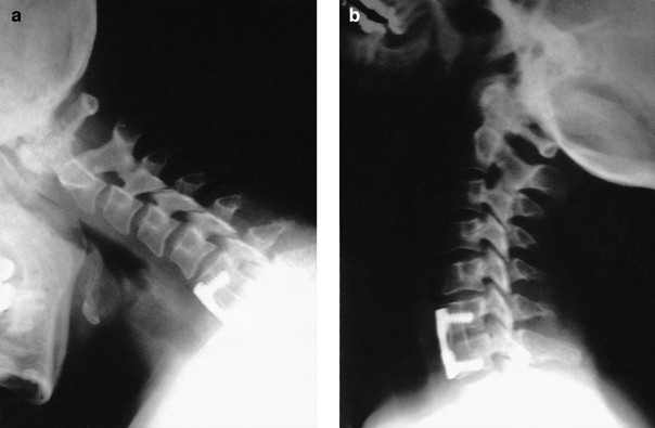 Unilateral cervical facet fracture: presentation of two cases and ...