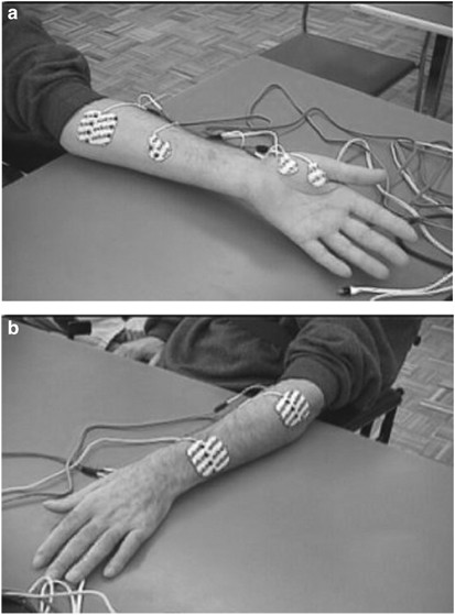 Functional electrical therapy: retraining grasping in spinal cord ...