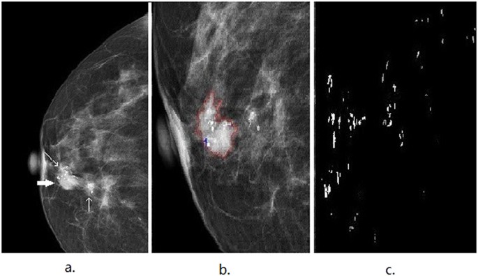 Discrimination of Breast Cancer with Microcalcifications on Mammography by Deep Learning ...