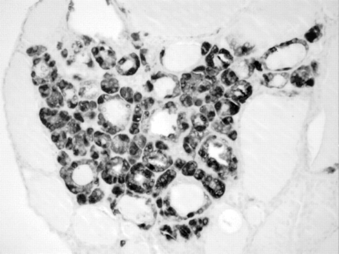 C-Cell Hyperplasia and Medullary Thyroid Carcinoma: Clinicopathological ...