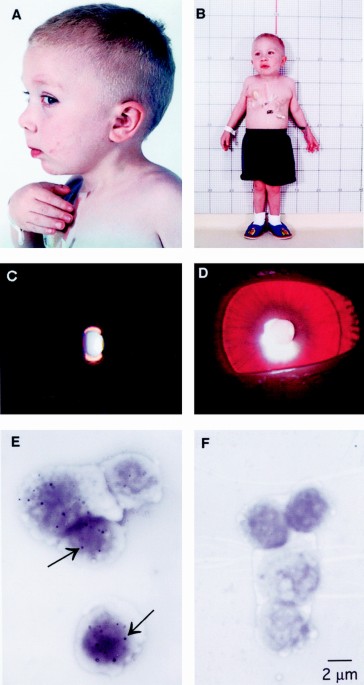 Hermansky Pudlak Syndrome