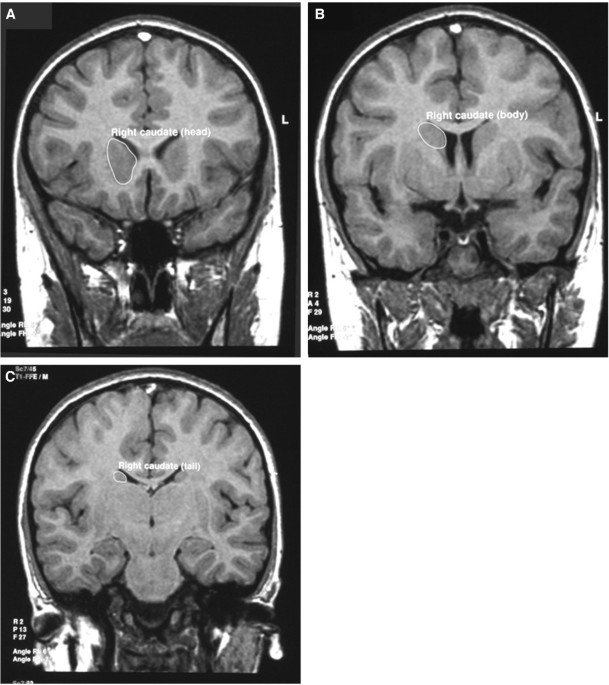 Caudate and Hippocampal Volumes, Intelligence, and Motor Impairment in ...