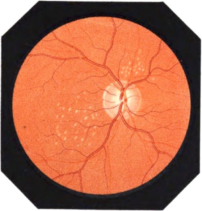 Elusive drusen and changing terminology of AMD | Eye