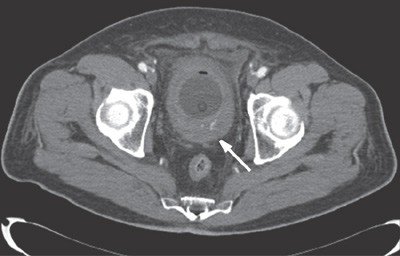 Treatment of a patient with post-TURP hemorrhage using bilateral SAPE ...