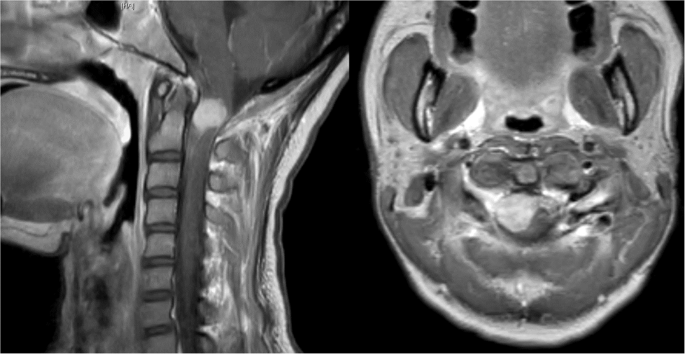 A curious cervical spine case: multiple, primary CNS leiomyosarcomas ...