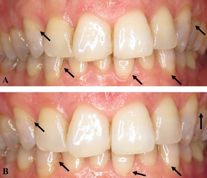 Remediation of adult black dental stains by phototherapy | BDJ Open