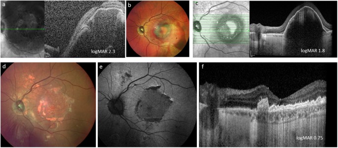 Cellular regeneration strategies for macular degeneration: past ...
