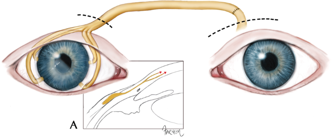 Anatomic characteristics of supraorbital and supratrochlear nerves ...