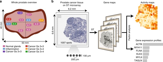 Spatial maps of prostate cancer transcriptomes reveal an unexplored ...
