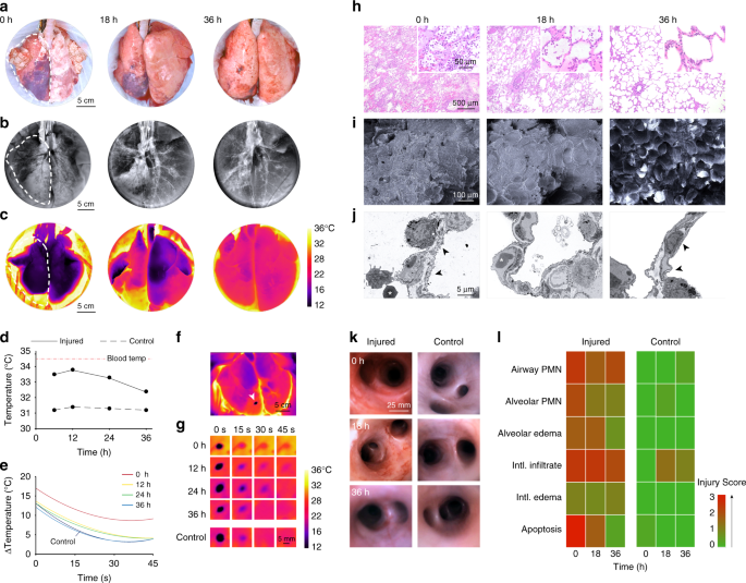 Regeneration of severely damaged lungs using an interventional cross ...