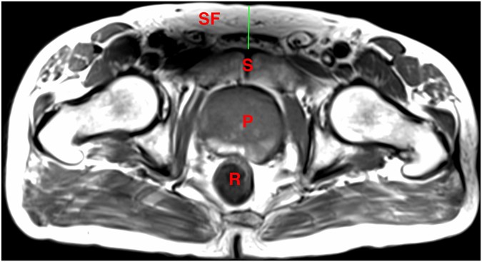 Normalized periprostatic fat MRI measurements can predict prostate ...