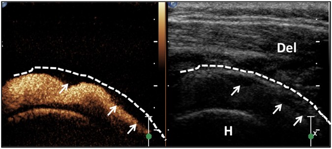 Adhesive Capsulitis of the Shoulder: Evaluation With US-Arthrography ...