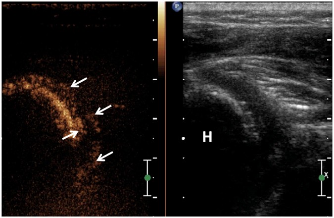 Adhesive Capsulitis of the Shoulder: Evaluation With US-Arthrography ...