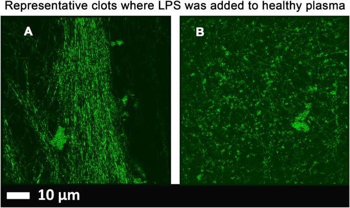 Lipopolysaccharide-binding protein (LBP) reverses the amyloid state of ...