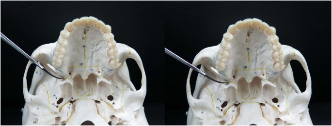 The pterygomaxillary junction: An imaging study for surgical ...