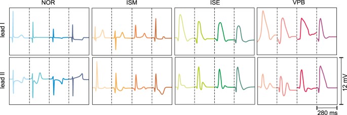 ECG features and methods for automatic classification of ventricular ...