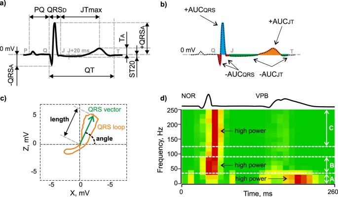 ECG features and methods for automatic classification of ventricular ...