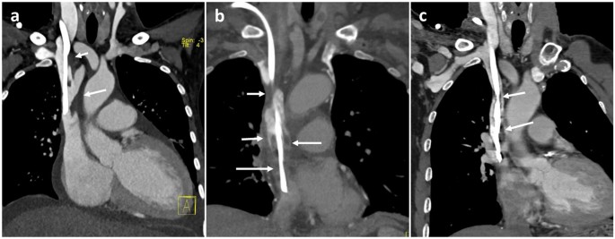 Numerical Simulation of Hemodynamic Changes in Central Veins after ...
