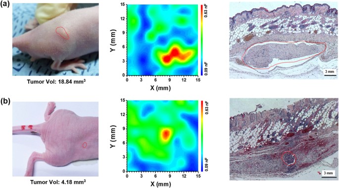 Dielectric imaging for differentiation between cancer and inflammation ...