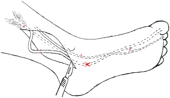 Anatomical Study of the Neurovascular in Flexor Hallucis Longus Tendon ...