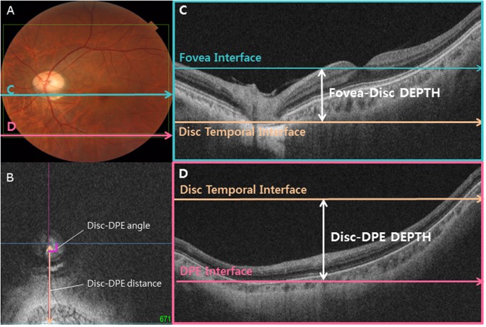 Three Dimensional Evaluation of Posterior Pole and Optic Nerve Head in ...