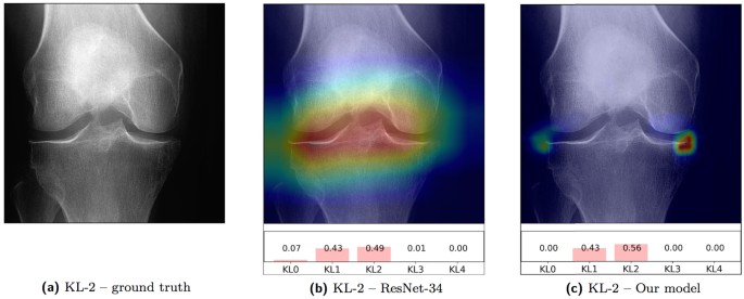 Automatic Knee Osteoarthritis Diagnosis from Plain Radiographs: A Deep ...
