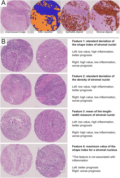 Computationally-Guided Development of a Stromal Inflammation Histologic ...