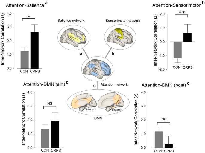 Altered attentional control over the salience network in complex regional pain syndrome ...