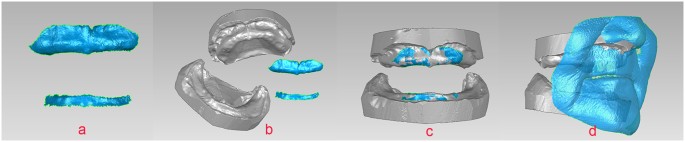 A pilot study of digital recording of edentulous jaw relations using a handheld scanner and ...