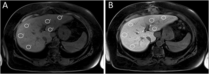 Hepatobiliary MRI: Signal intensity based assessment of liver function ...
