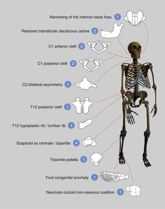 Skeletal Anomalies in The Neandertal Family of El Sidrón (Spain ...