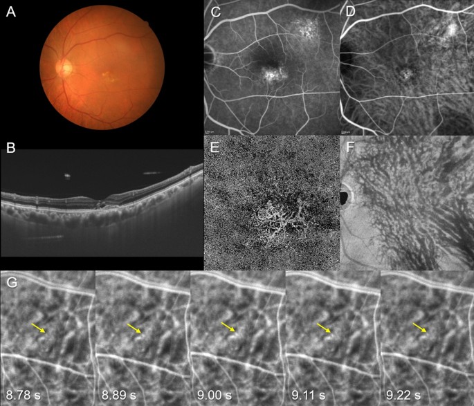 Pulsation of anastomotic vortex veins in pachychoroid spectrum diseases ...