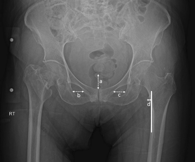 Risk factors for templating mismatch of uncemented stems in bipolar ...