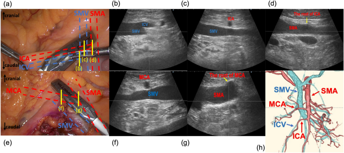 Usefulness of intraoperative ultrasound examination for laparoscopic ...