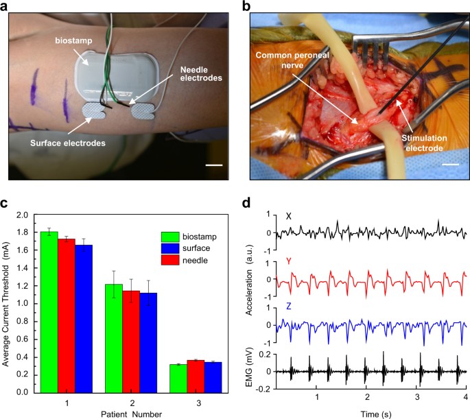 Intraoperative monitoring of neuromuscular function with soft, skin ...