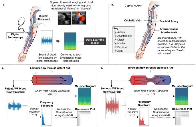 Deep learning analysis of blood flow sounds to detect arteriovenous ...