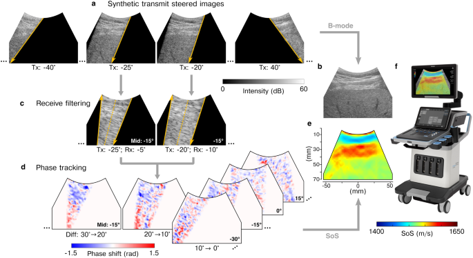 First-in-human diagnostic study of hepatic steatosis with computed ultrasound tomography in echo ...