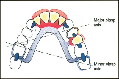 Indirect retention | British Dental Journal