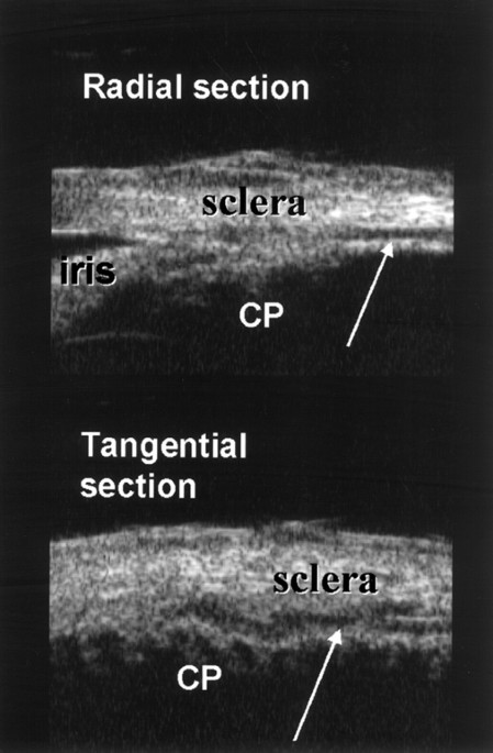 Ciliary body arteriovenous malformation? | Eye