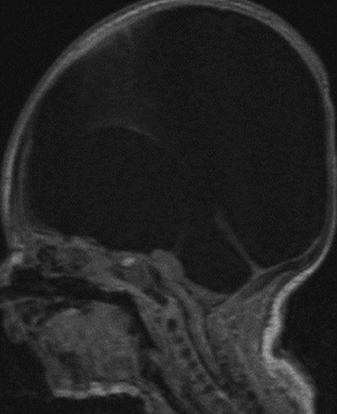 Een ‘bijzonder’ waterhoofd bij pasgeborenen | SpringerLink