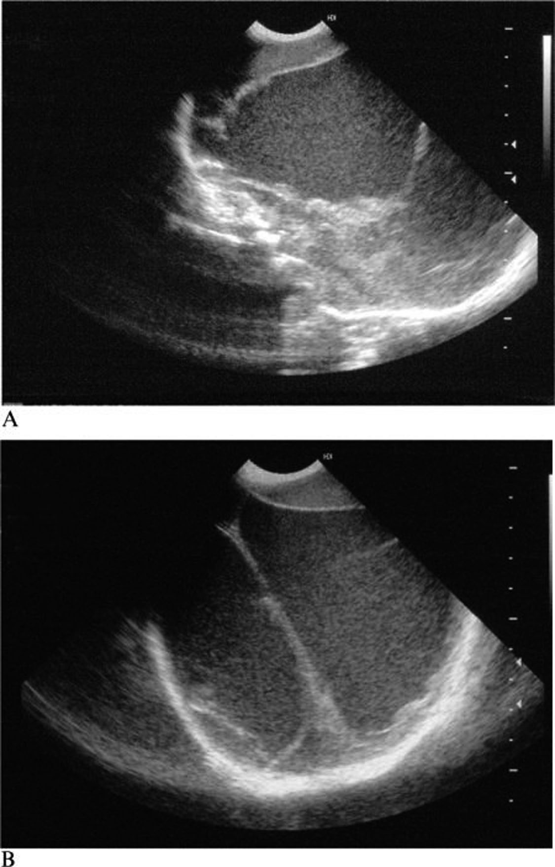 Een ‘bijzonder’ waterhoofd bij pasgeborenen | SpringerLink