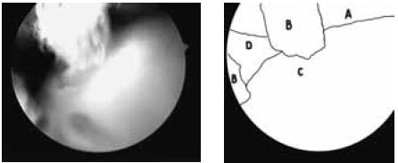 Artroscopisch geleide behandeling van syndesmoseletsel | SpringerLink