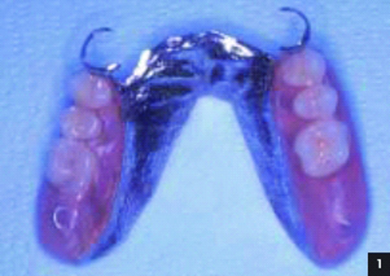 De partiële frameprothese en het parodontium | SpringerLink