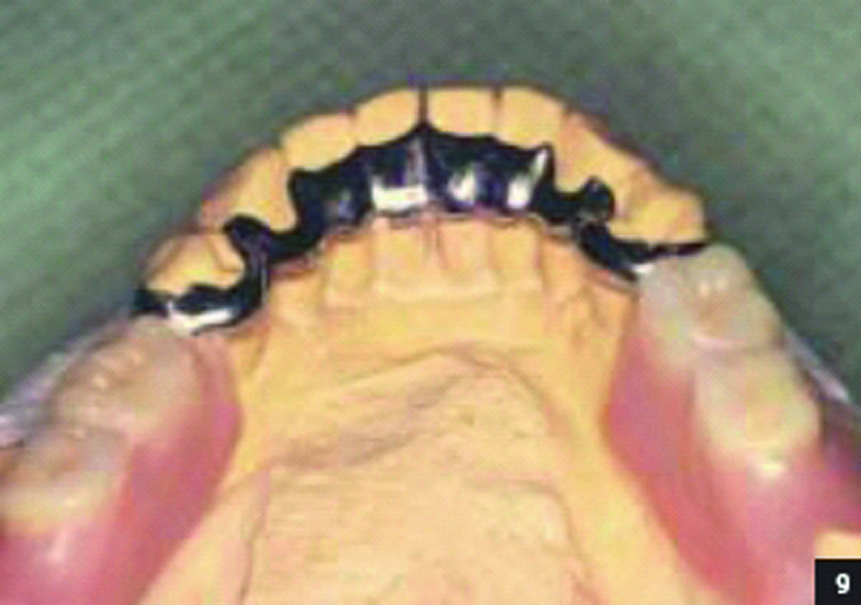 De partiële frameprothese en het parodontium | SpringerLink