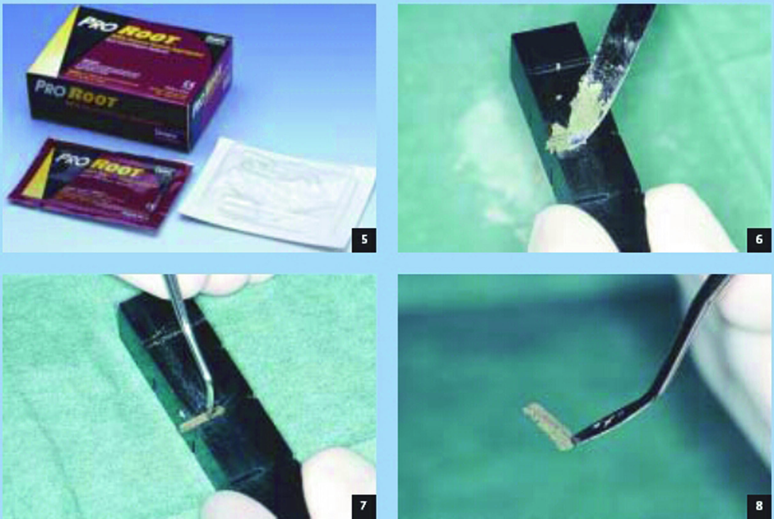 Super EBA-cement en MTA als retrograde vulmaterialen | SpringerLink