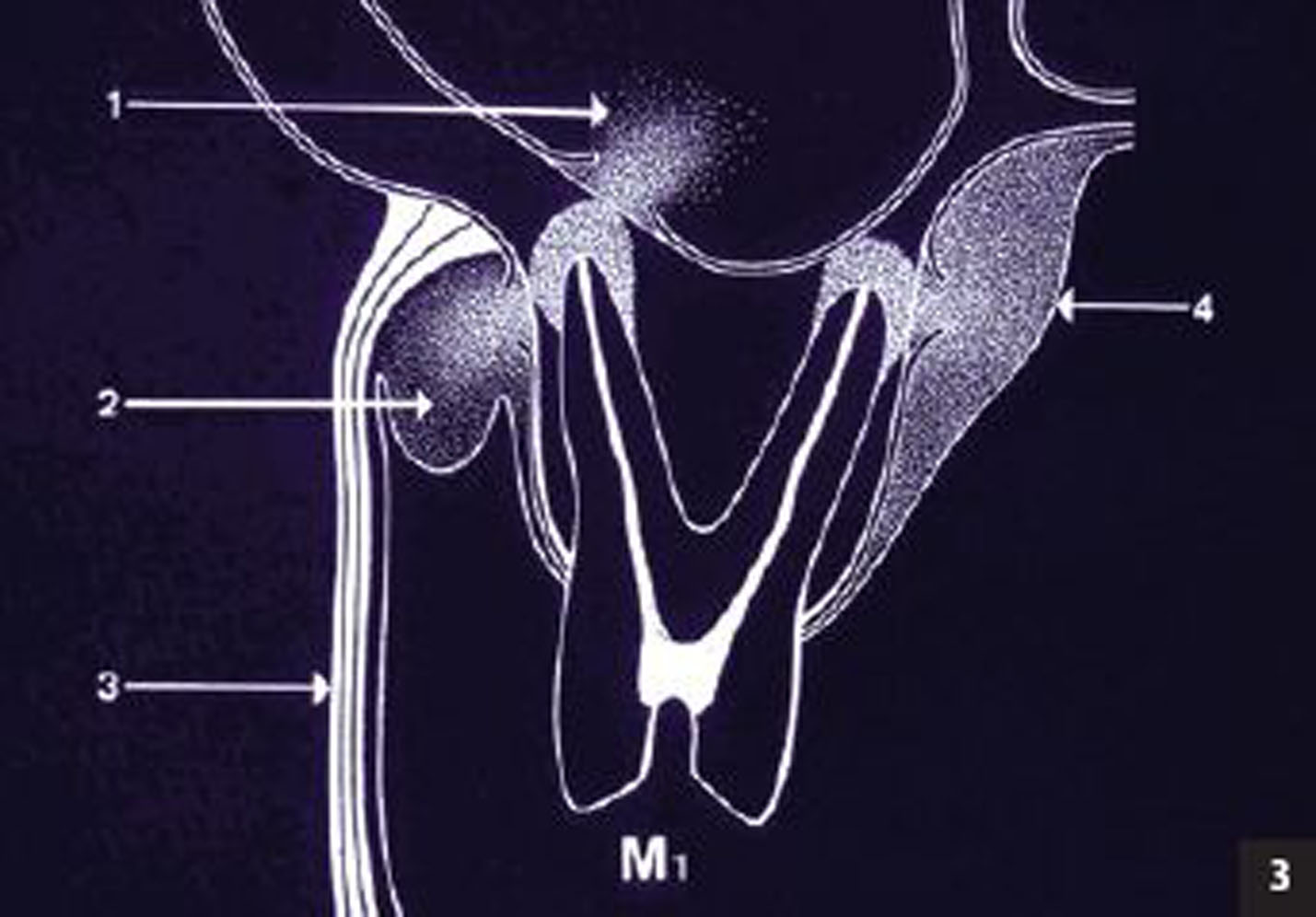Dentogene loge-abcessen in het hoofd-halsgebied | SpringerLink