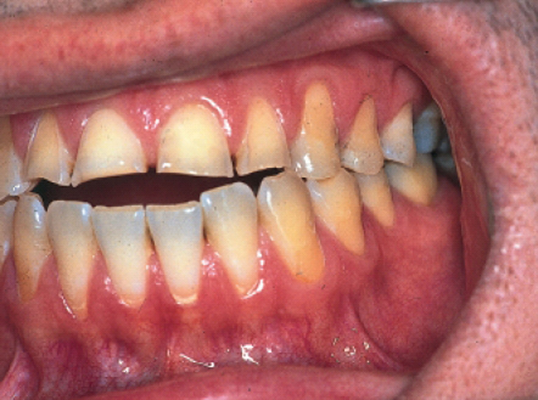 Tanderosie | SpringerLink