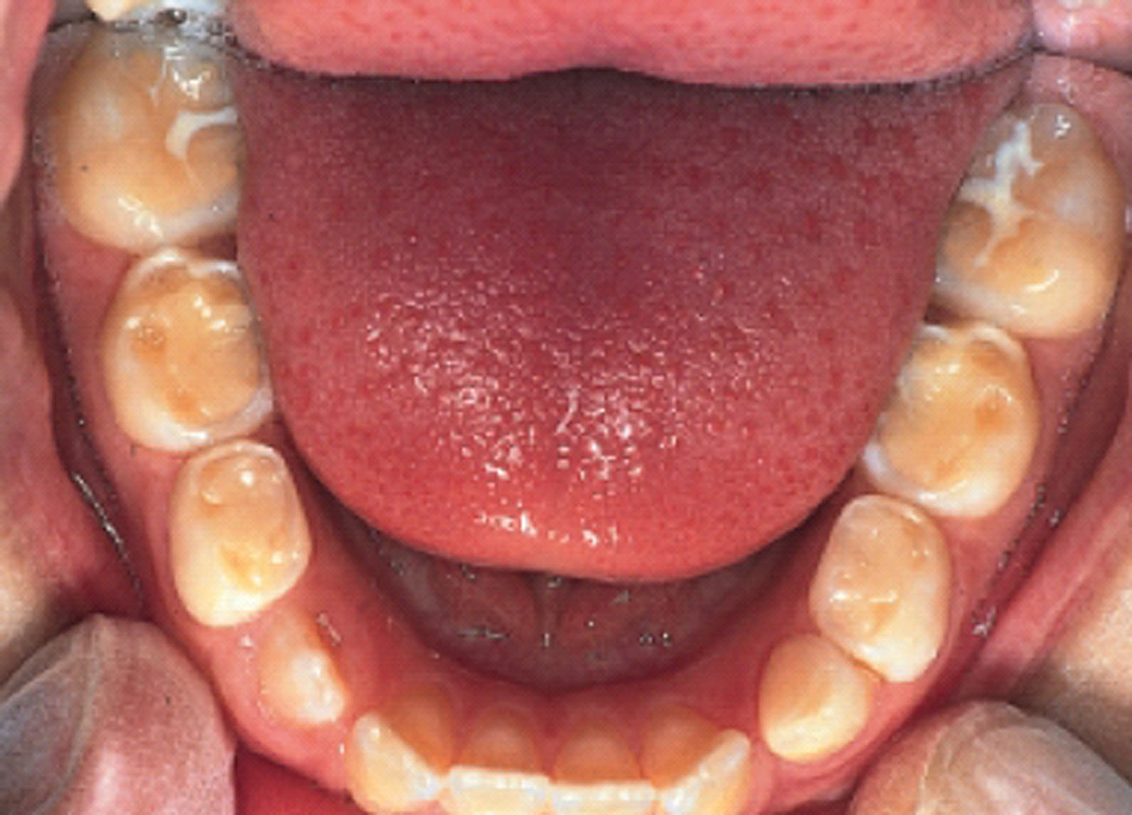 Tanderosie | SpringerLink