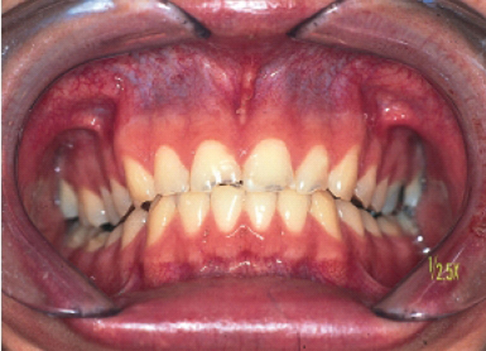 Tanderosie | SpringerLink